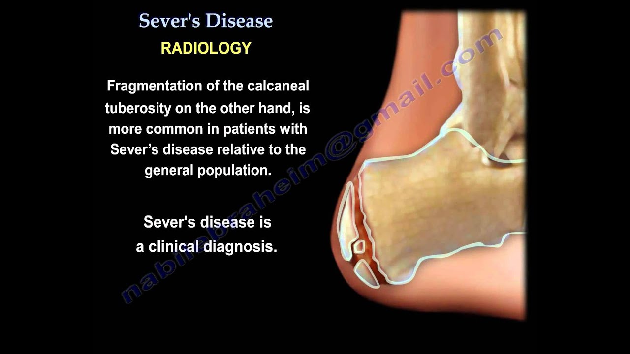 Sever s Disease Everything You Need To Know Dr Nabil Ebraheim