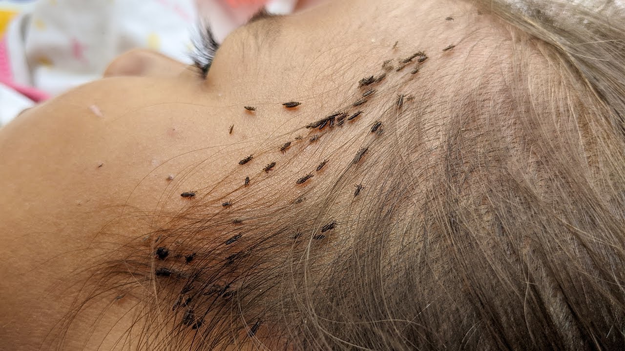 Remove thousand lice from long hair - Getting out all of big lice from ...