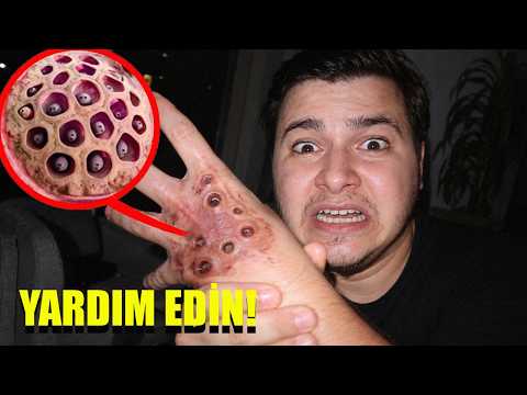 Elinizde BÖYLE DELİKLER Görürseniz HEMEN Hastaneye Koşun! (İÇİNDE BİR ŞEYLER VAR..)