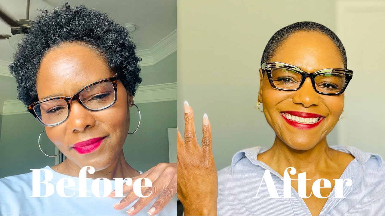 Hair Loss Is So Real, Why I Went From Having Hair To Having Little To ...