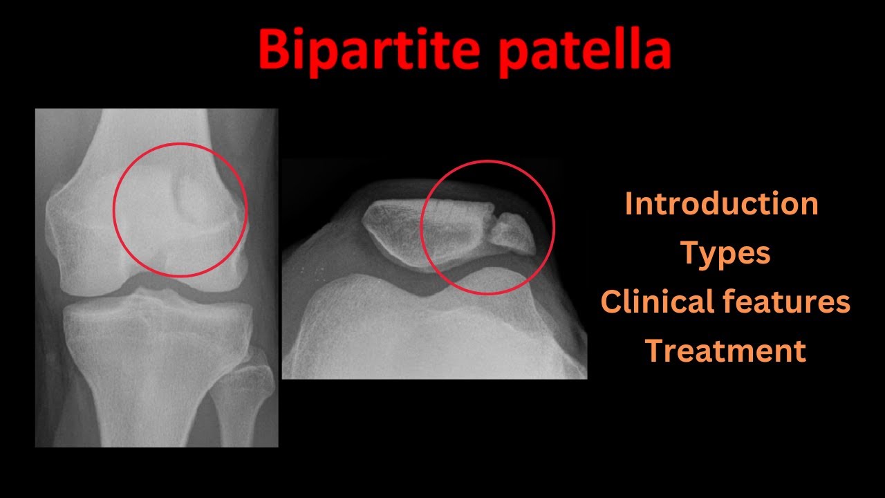 Bipartite Patella: Introduction, types, clinical features & treatment ...