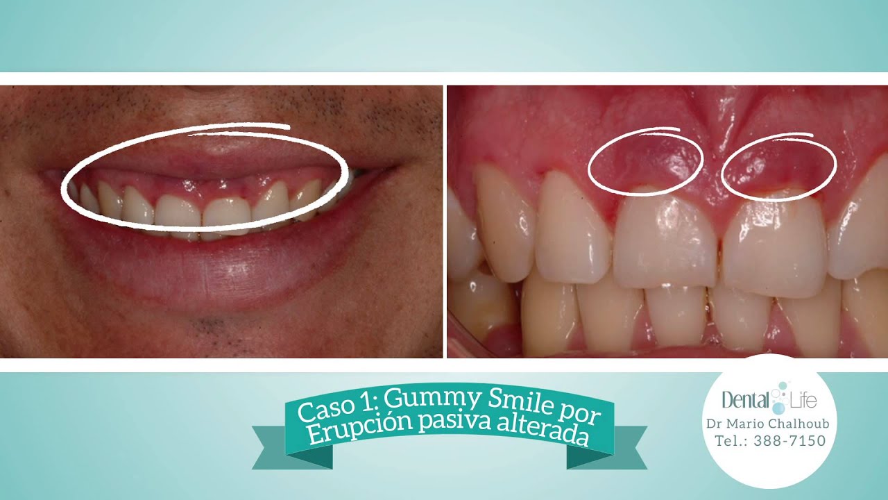Gummy Smile o Sonrisa de Encias Doctor Mario Chalhoub Dental Life - YouTube