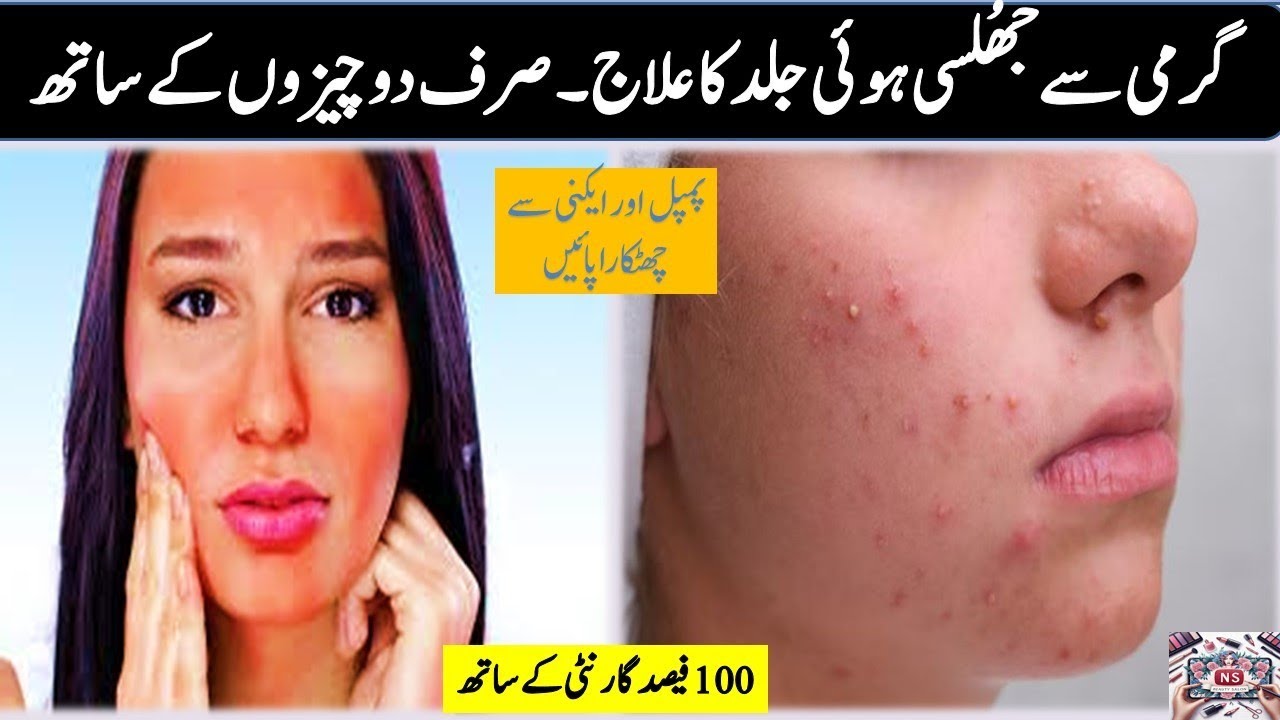 How to repair Skin burn | skin burn solution at home |NS Beauty Saloon ...