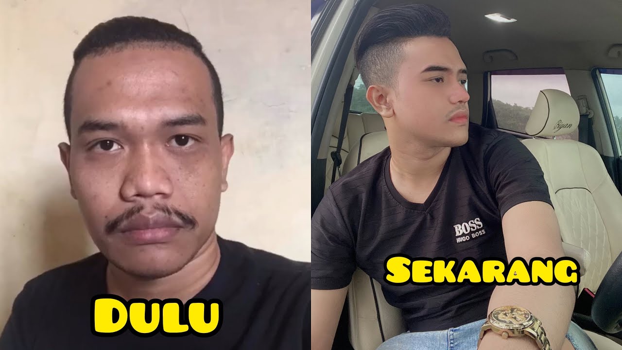 NOSE JOB INDONESIA RHINOPLASTY PLASTIC SURGERY OPERASI HIDUNG INDONESIA ...