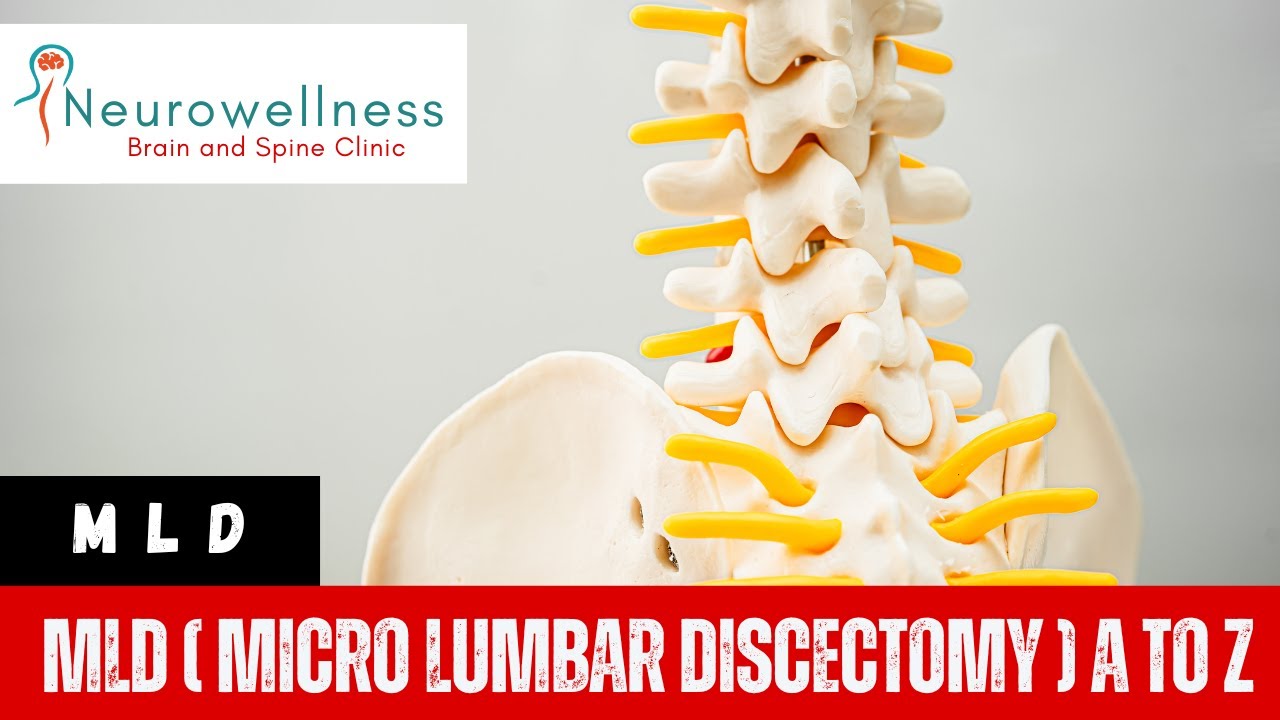 MLD ( micro lumbar discectomy ) A to Z (Know Everything about MID ...