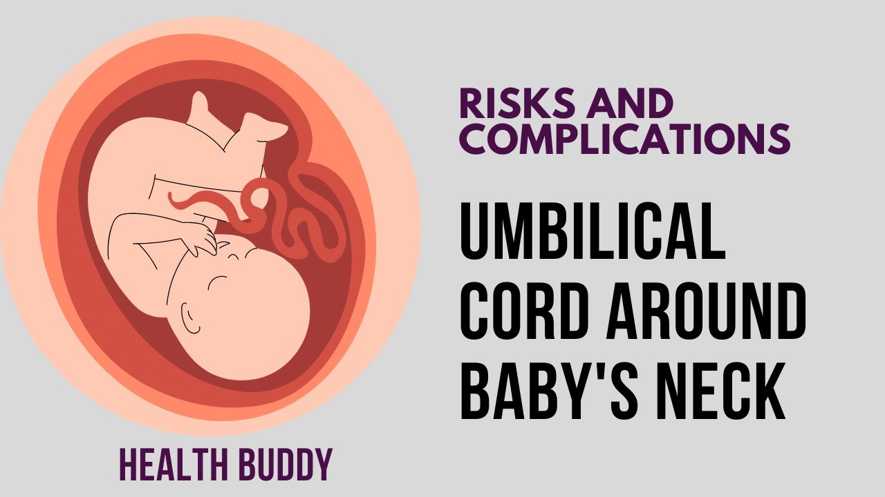 Umbilical Cord Wrapped Around Baby's Neck Risks, Myths, and Facts ...