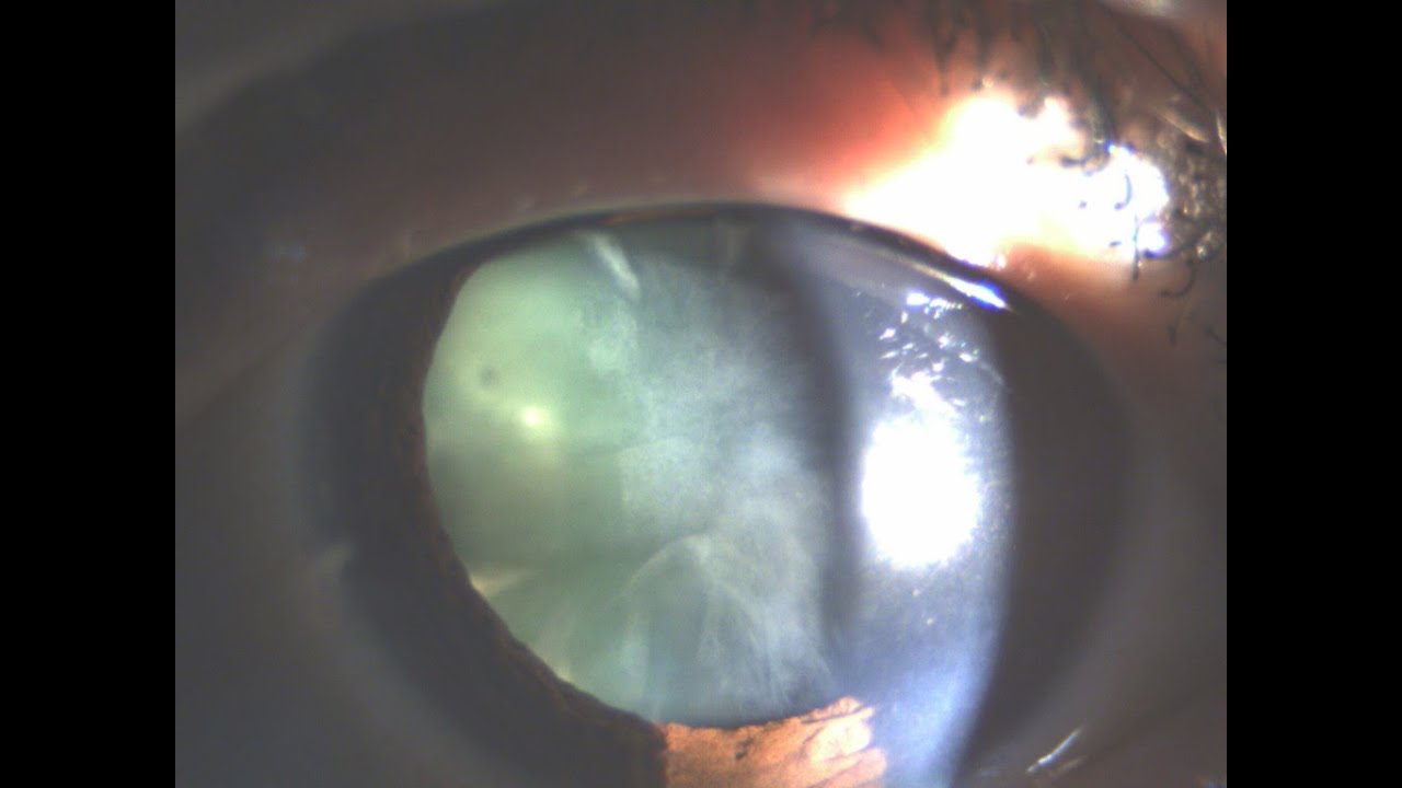 cortical cataract phaco chop eyhance IOL - YouTube