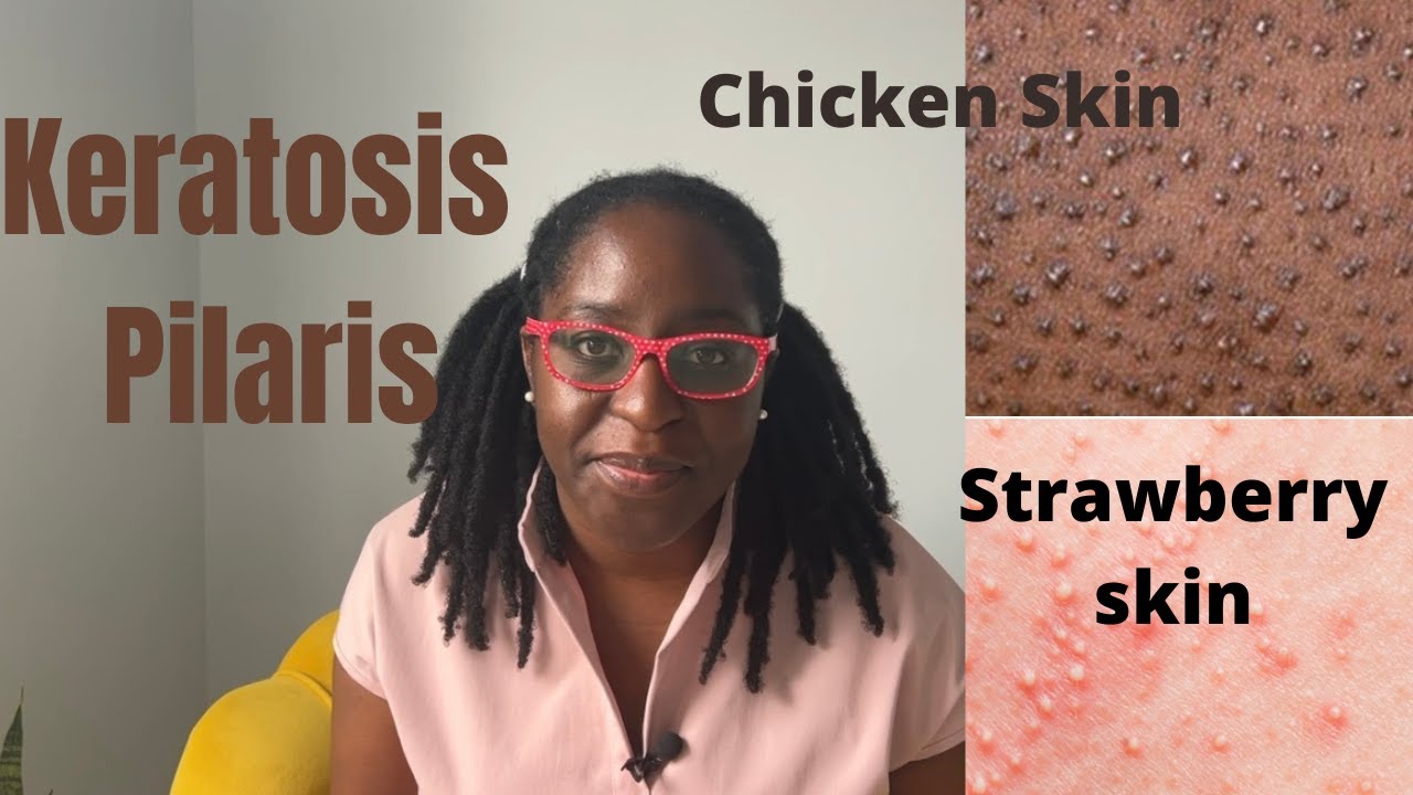 Keratosis Pilaris Chicken Skin - YouTube