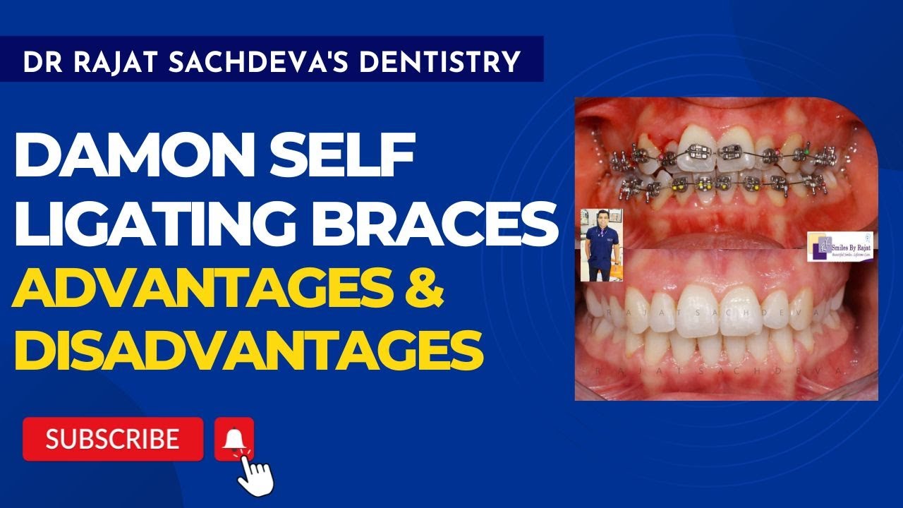 Damon System | Damon Braces in Delhi | Self Ligating Braces ...