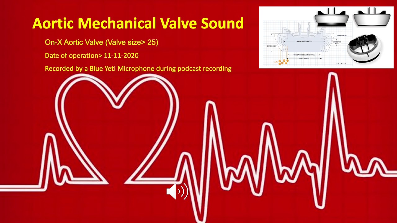 Mechanical Heart (Aortic) Valve Sound - YouTube