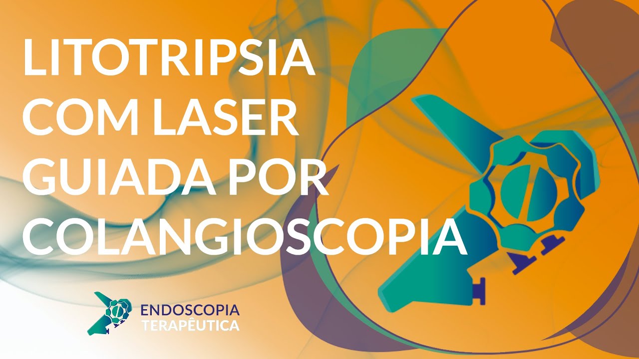 Litotripsia com laser guiada por Colangioscopia - YouTube