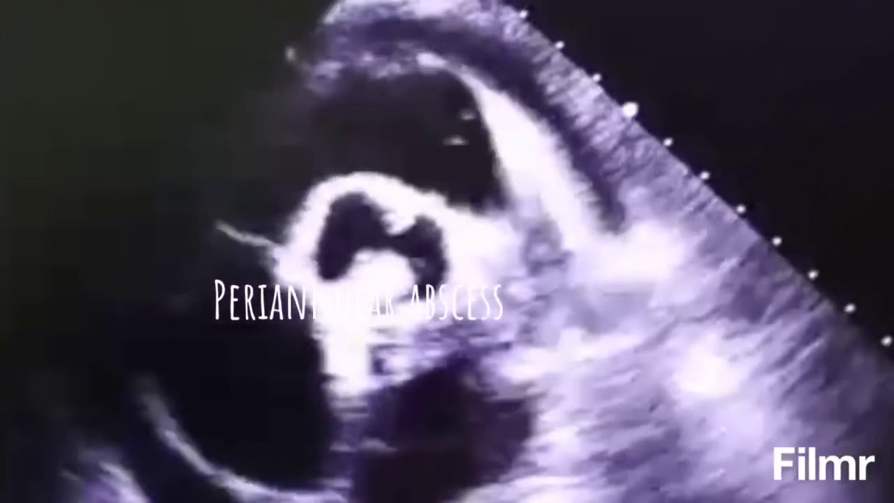 #periannular abscess #endocarditis #bicuspid aortic valve - YouTube