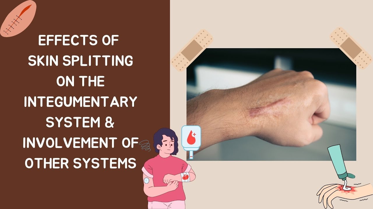 Effects of Skin Splitting on the Integumentary System & Involvement of ...