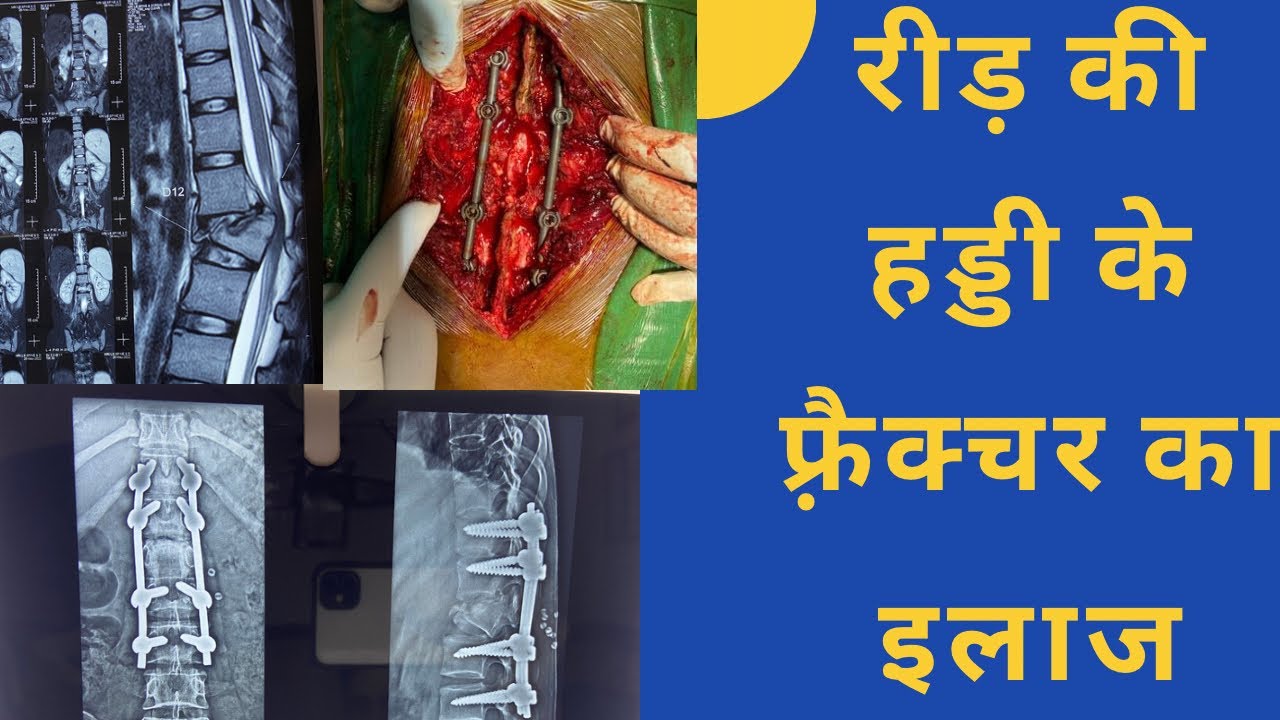 Total Recovery in a Patient with both leg paralysis after spinal injury ...