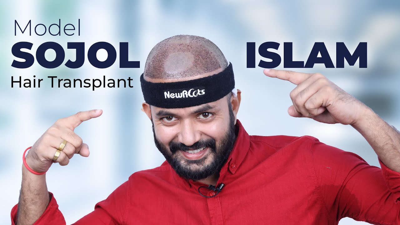 Model Sojol Islam's Hair Transplant Journey at New Roots Clinic, Dhaka ...