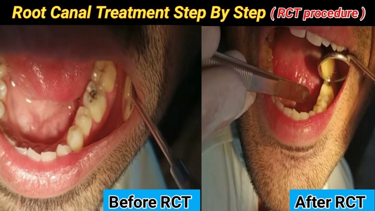 Root Canal Treatment Step BY Step (RCT) | Endodontic Treatment ...