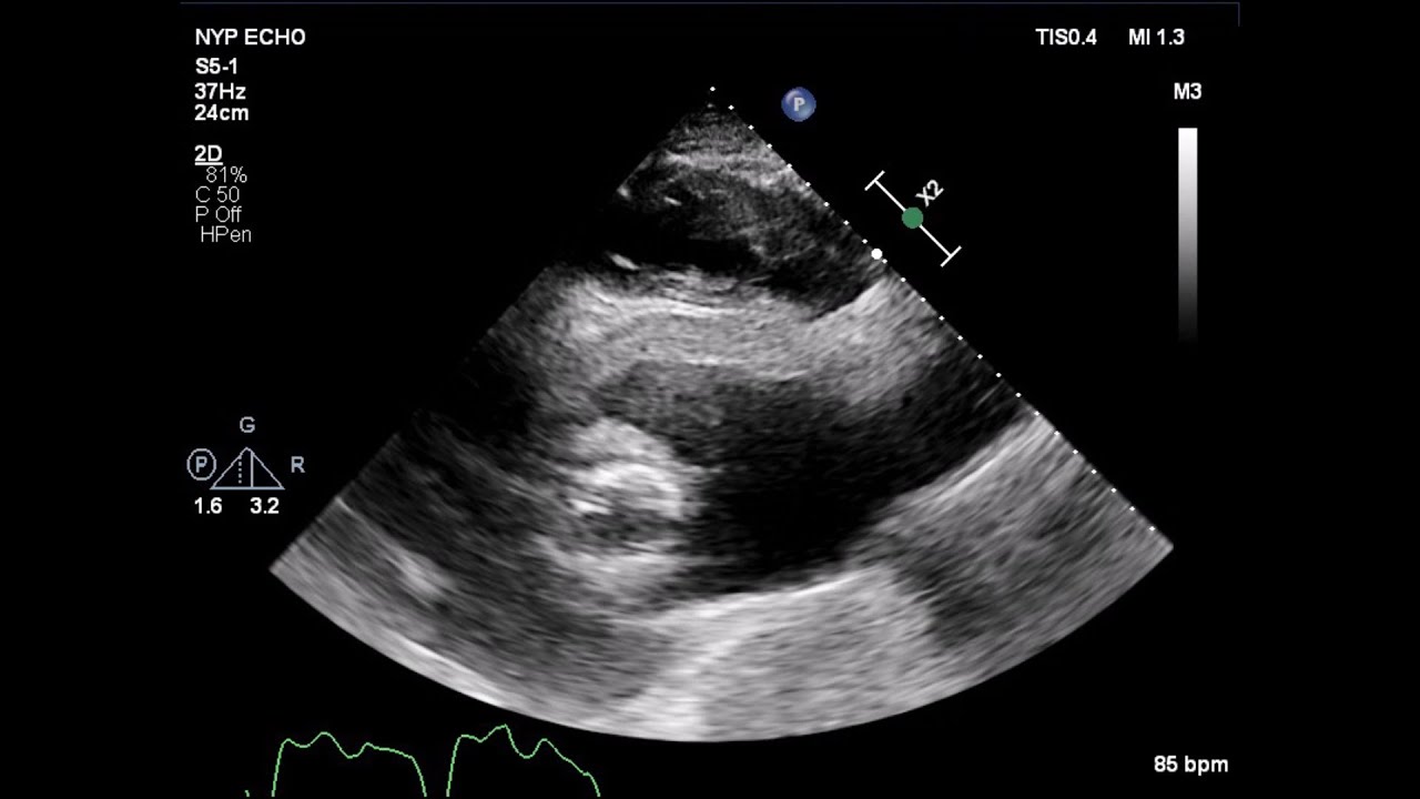 Thoracic Aortic Aneurysm Compression of the Left Ventricle - YouTube