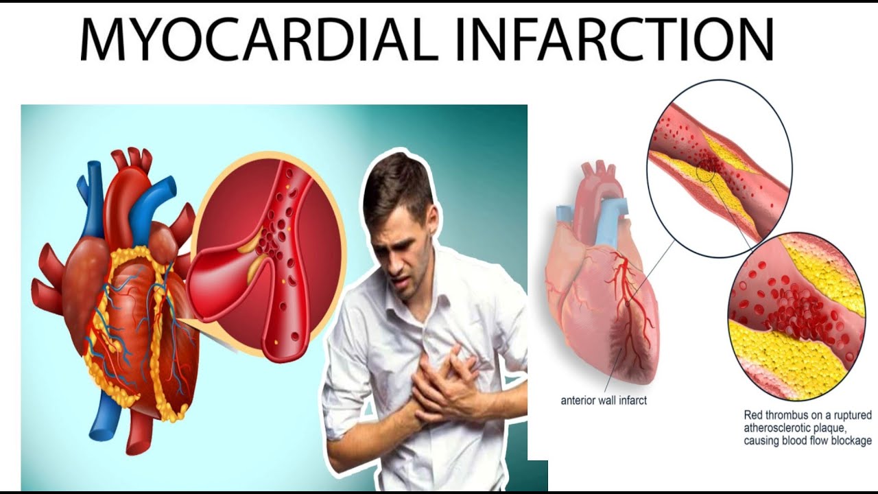 Myocardial Infarction (MI) // Emergency Treatment // Step wise ...
