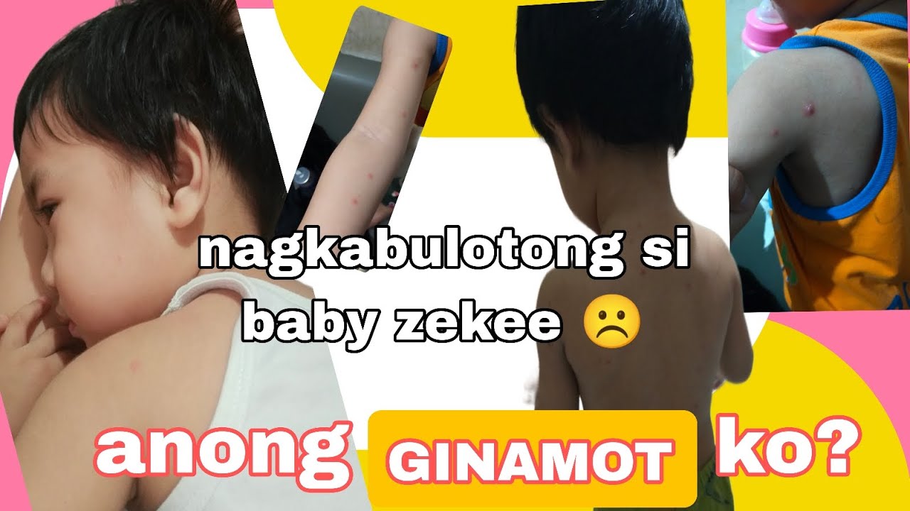 TODDLER CHICKEN POX|BULUTONG TUBIG|ANONG GAMOT - YouTube