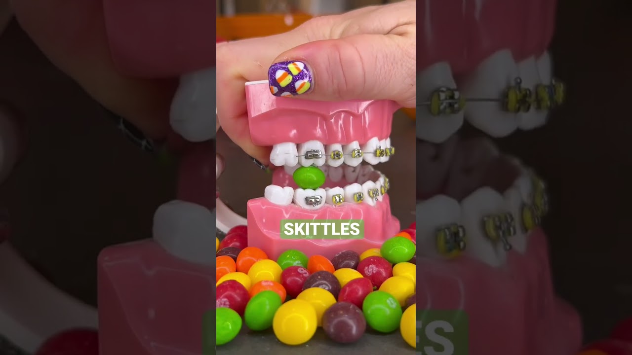 FOODS YOU CAN T EAT WITH BRACES braces teeth candy snacks shorts foods-you-can-t-eat-with-braces-braces-teeth-candy-snacks-shorts