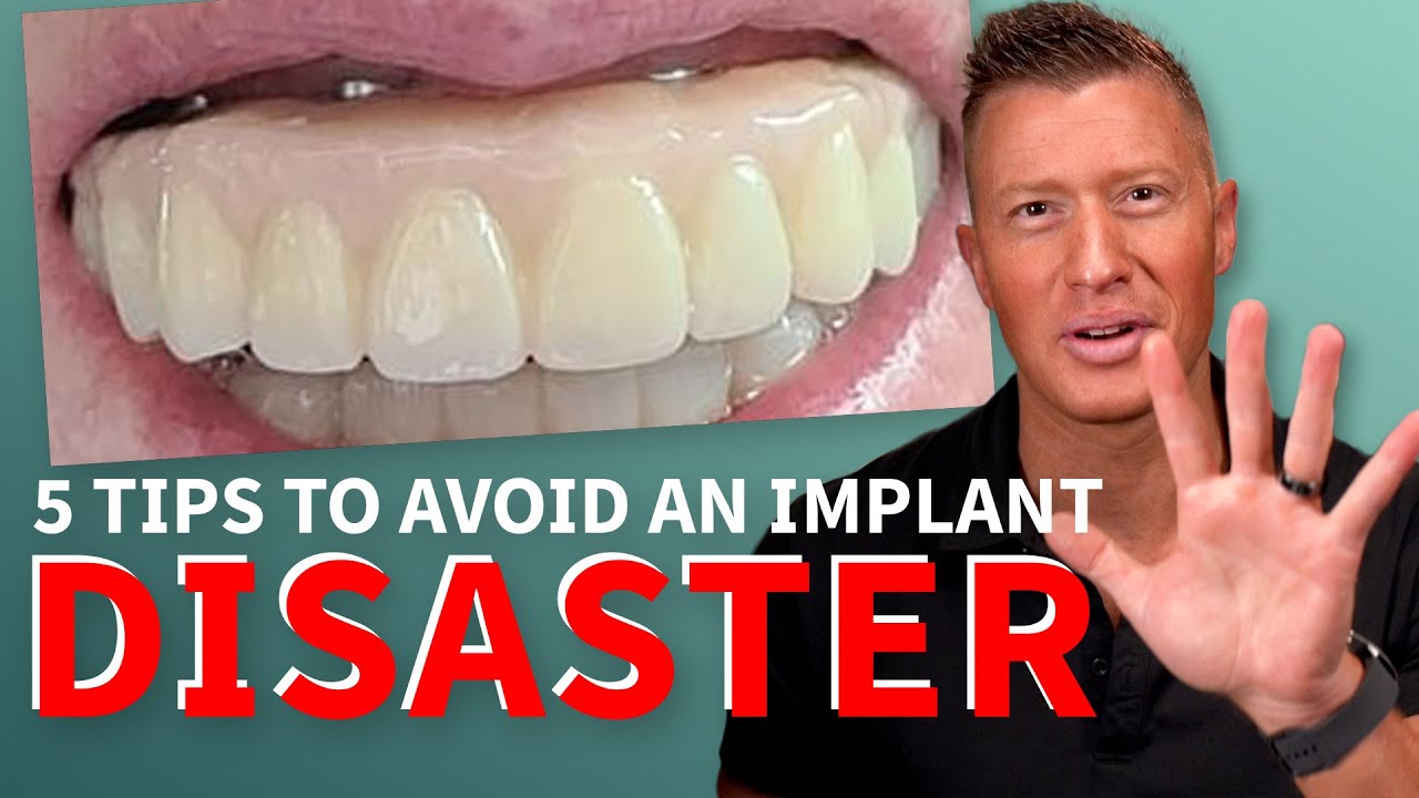 5 Tips to ESCAPE DISASTER with your All-on-4 Smile, All-on-6, Full ...