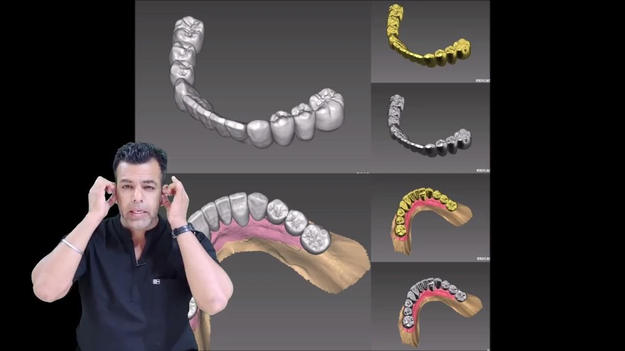 Learn about Anterior Deprogrammer | Muscle Deprogramming | Full Mouth ...
