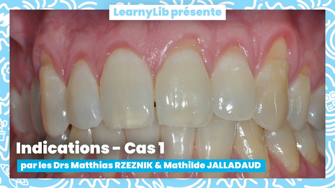 🦷 La chirurgie muco-gingivale : les indications de la greffe épithélio ...