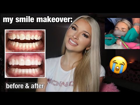 MY SMILE MAKEOVER | GETTING PORCELAIN CROWNS | $$$, pain, experience, BEFORE & AFTER, & more!