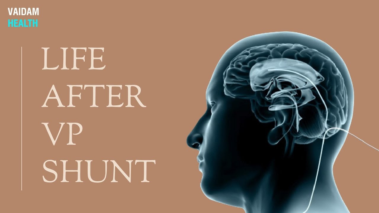 Life after VP Shunt - YouTube