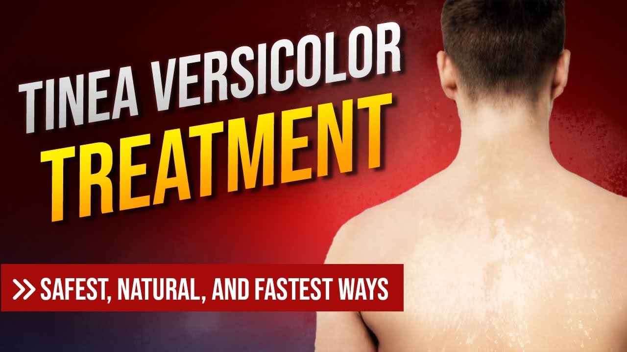 Home Cure For Tinea Versicolor - Homemade Ftempo