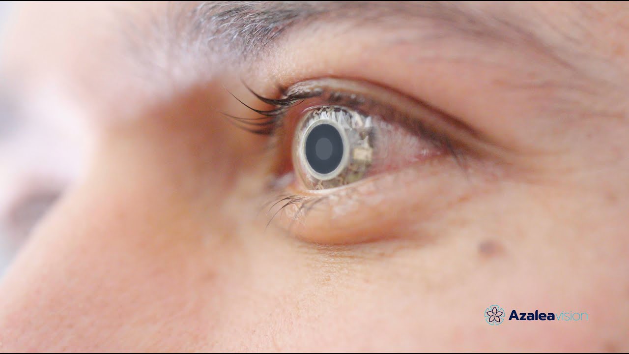 ALMA lens, the revolutionary smart contact lens by Azalea Vision - YouTube
