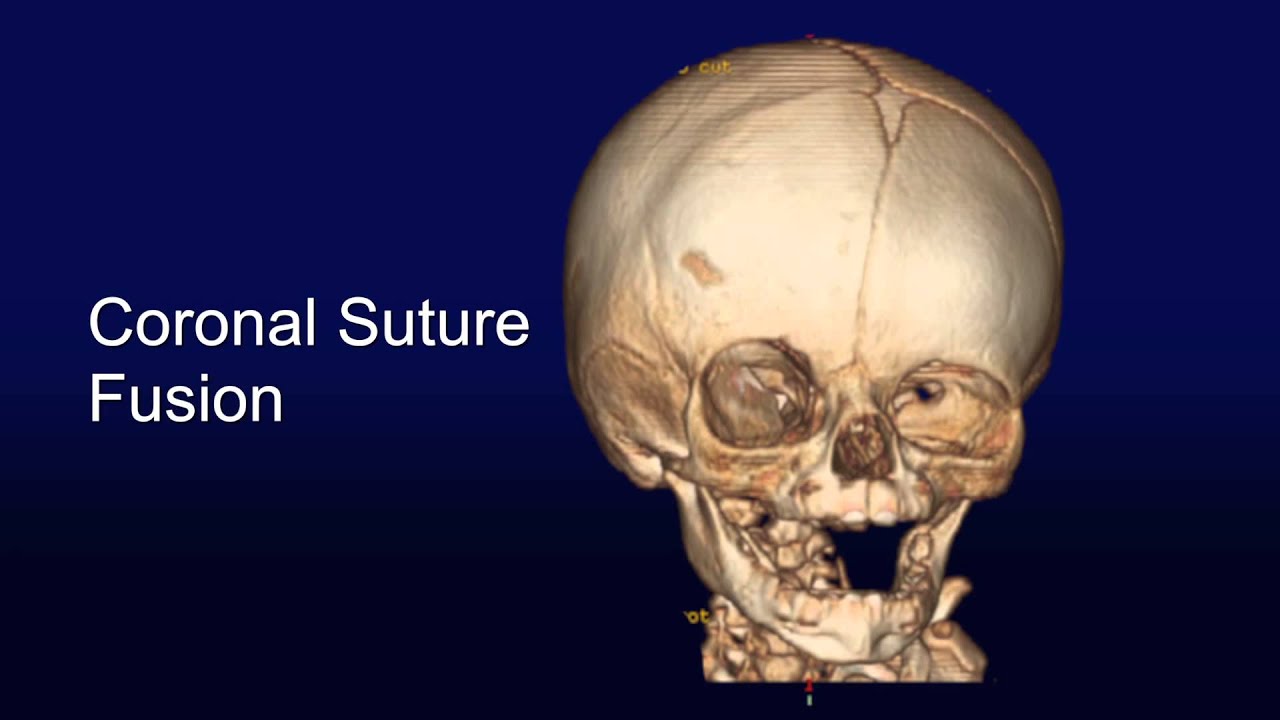 Craniosynostosis - YouTube