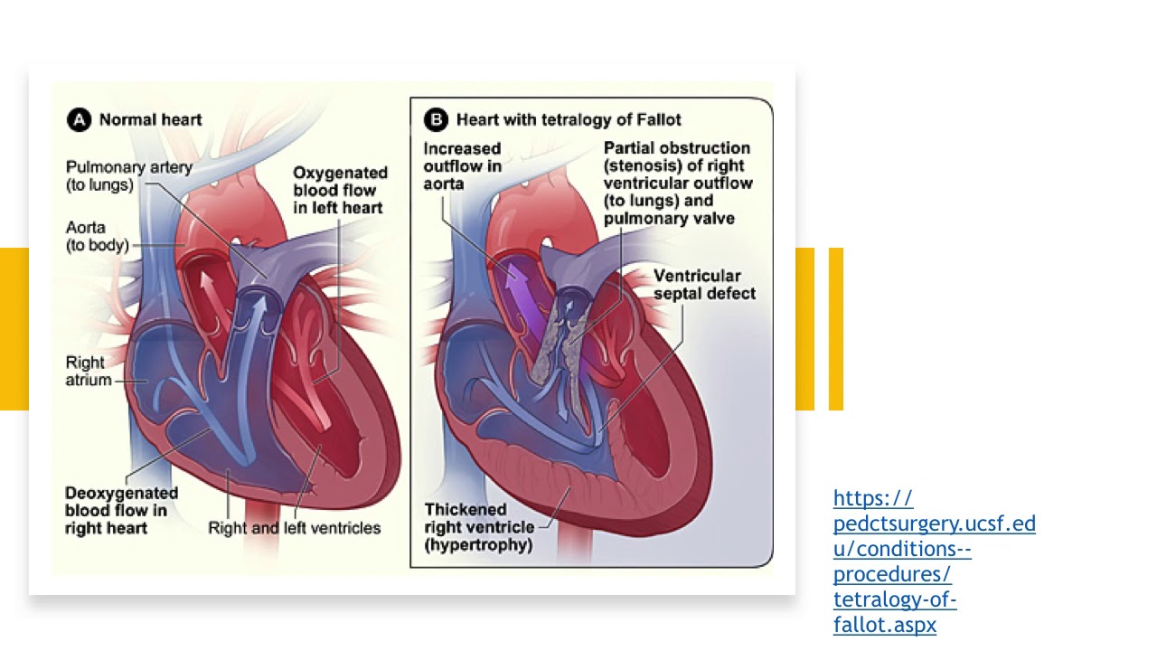 Congenital Heart Disease Lecture Series: Tetralogy of Fallot - YouTube