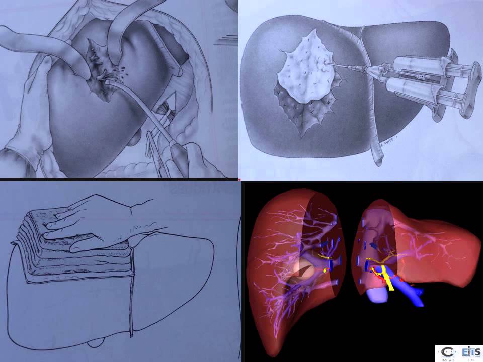 GASTRO-ENTEROLOGIE traumatisme abdominale - YouTube