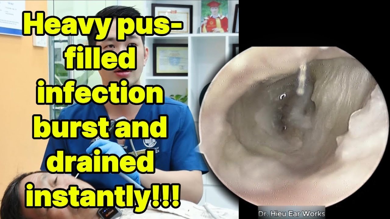Heavy pus filled infection burst and drained insta | ear cleaning ...