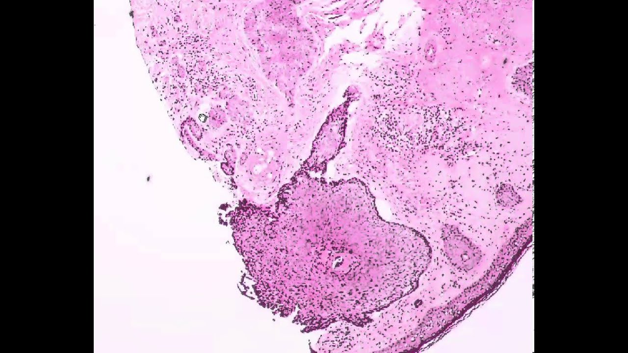 BCC on biopsy and wider excision - YouTube