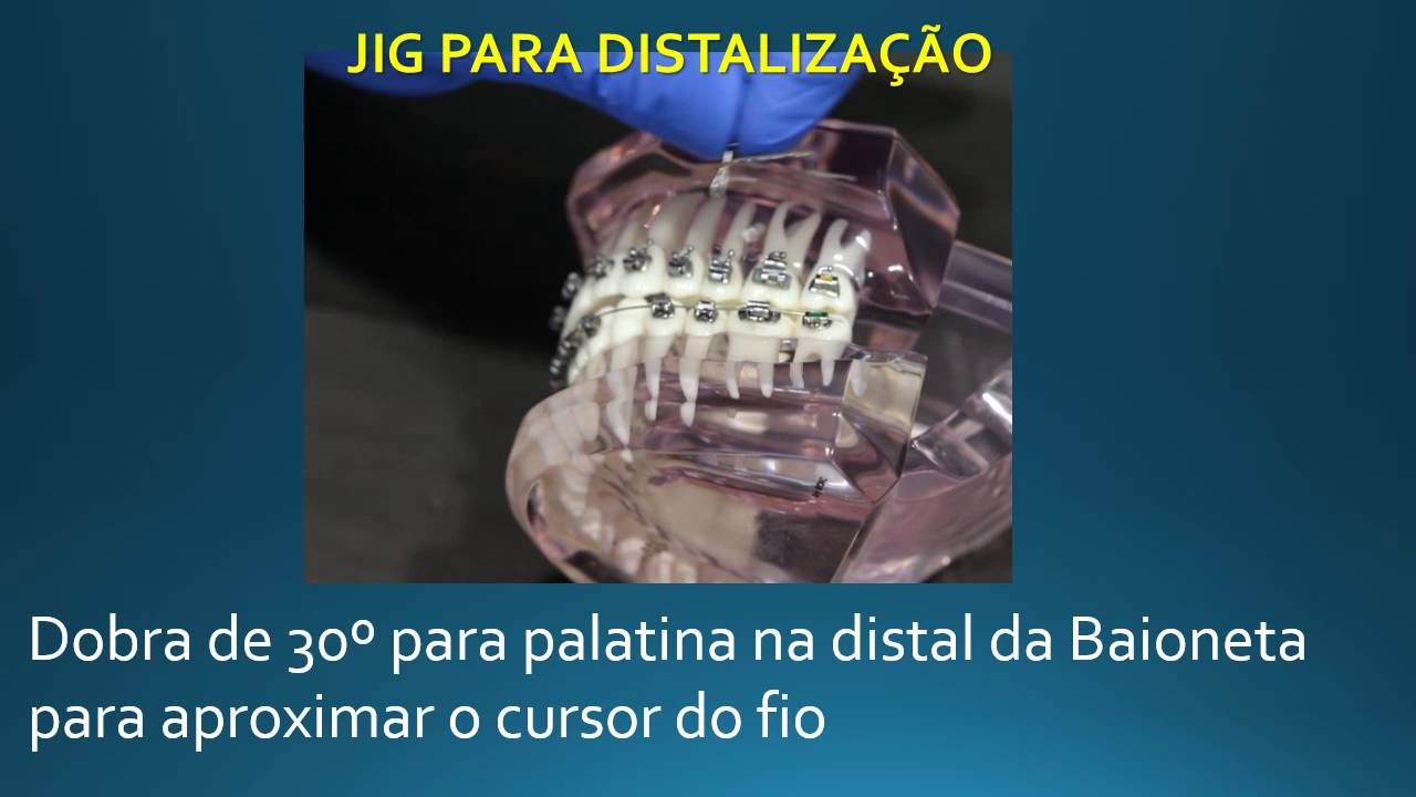 Jig para Distalização com Mini-Implantes - YouTube