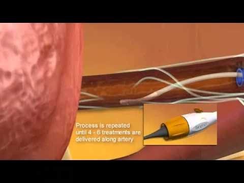Denervación Renal (RDN): Ardian (Medtronic) - YouTube