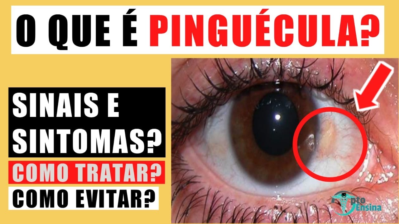 PINGUÉCULA: COMO AFECTA OS OLHOS?#dicas_prevenção #optoesina - YouTube