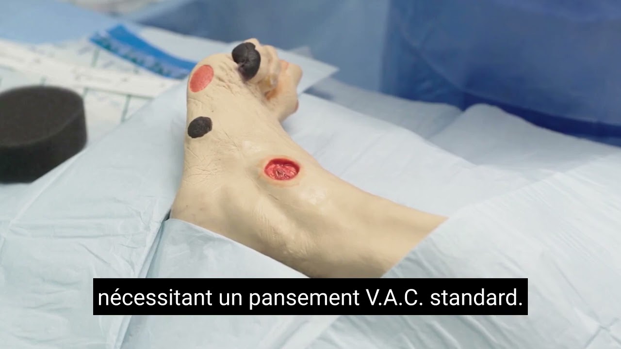 VAC Dressing Foot Wound Bridging Technique / Pansement VAC Technique de ...