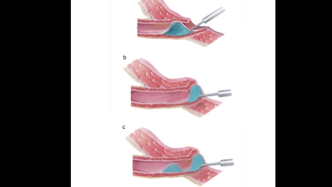 STING/ HIT procedure for grade 4 VUR in a patient with coagulopathy ...