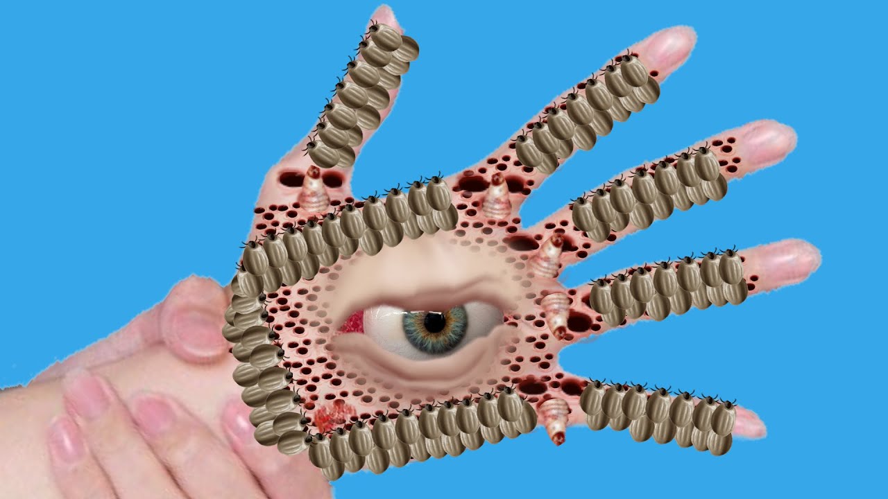 ASMR Treatment 2D Animation | Remove parasite on hand | @HealAsmr914K ...