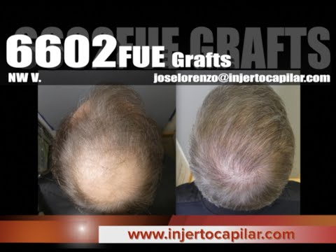 6602FUE Grafts. NW V. Thin/White hair. 2 surgeries. Psoriasis. Injertocapilar.com. 2533/2020