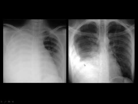 Hemotórax - YouTube