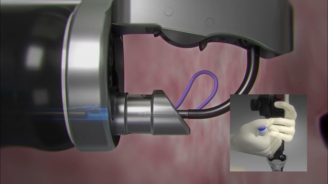 The OverStitch™ Endoscopic Suturing System | Obesity Control Center - YouTube