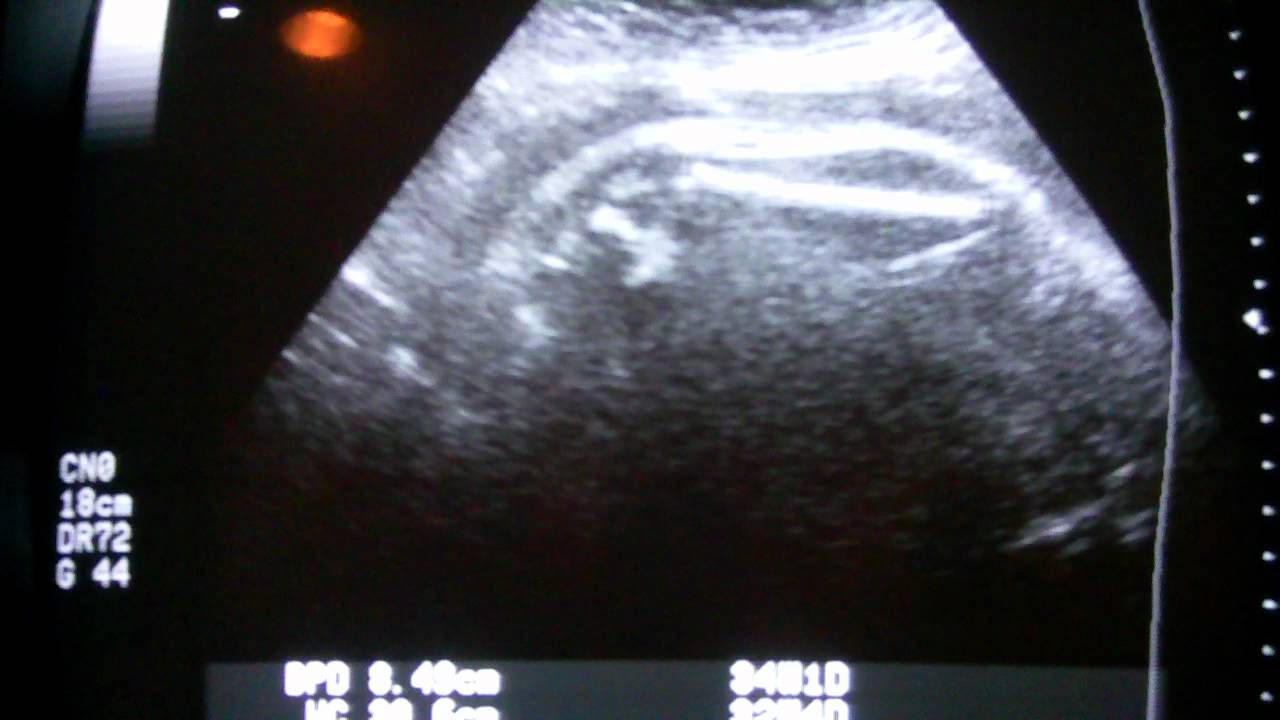 34 weeks pregnant ultrasound - YouTube