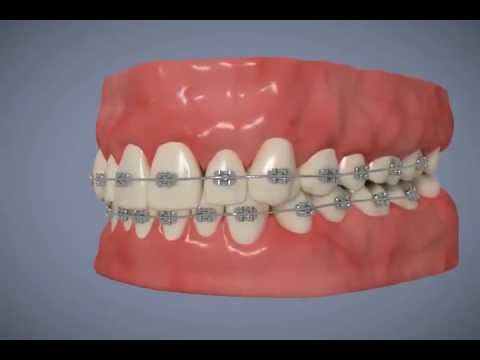 Bellevue WA Orthodontist Dr Barton Soper uses AcceleDent with Braces at ...