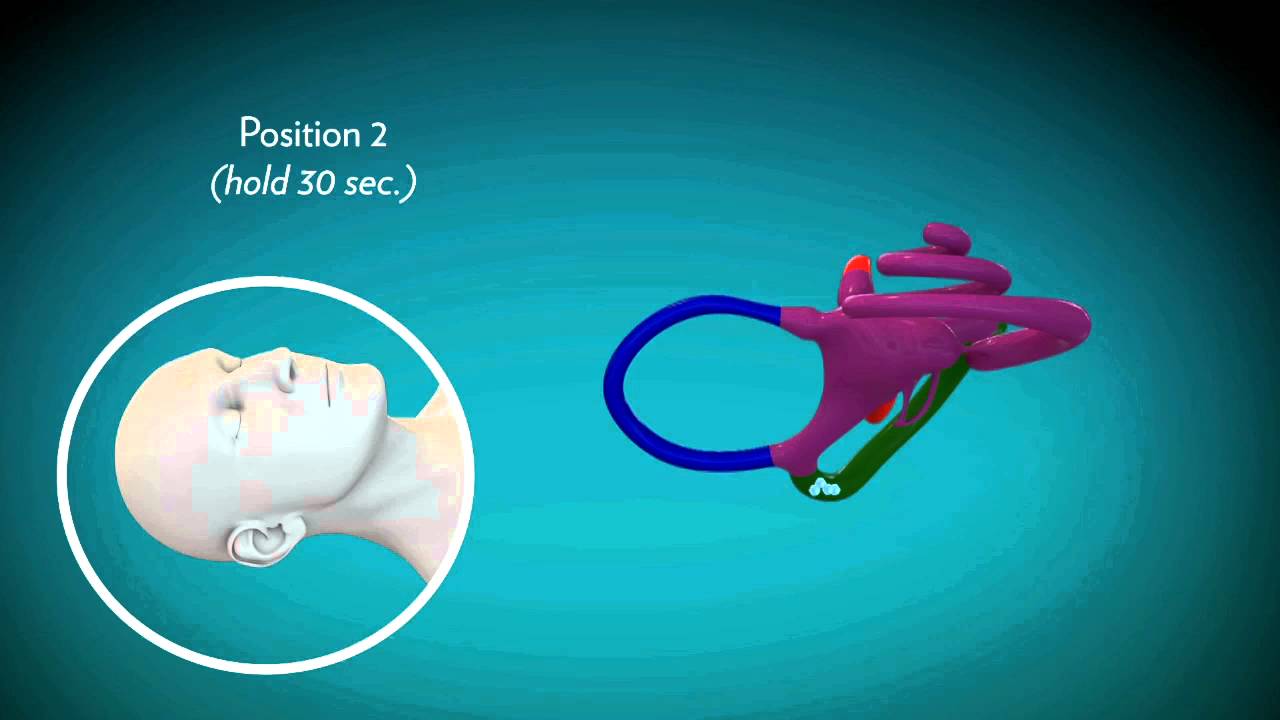 MUSC: BPPV Treatment Series Left Epley Maneuver - YouTube