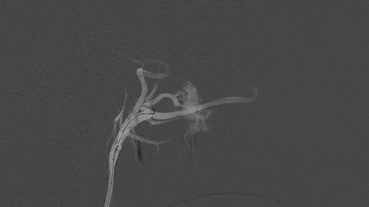 Transarterial embolization of an internal maxillary artery AVF ...