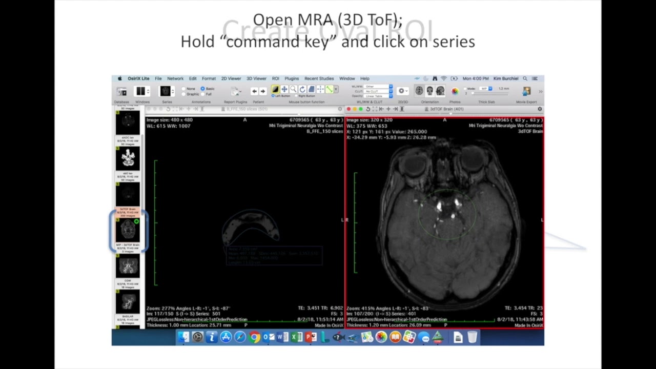 Osirix Meshlab processing - YouTube